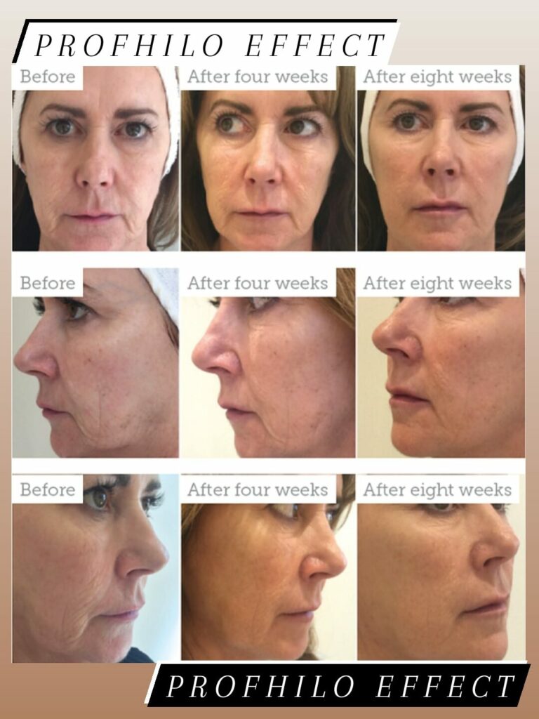 Get the 'injectable glow' -Profhilo - Dr Kara Cosmetic Clinic