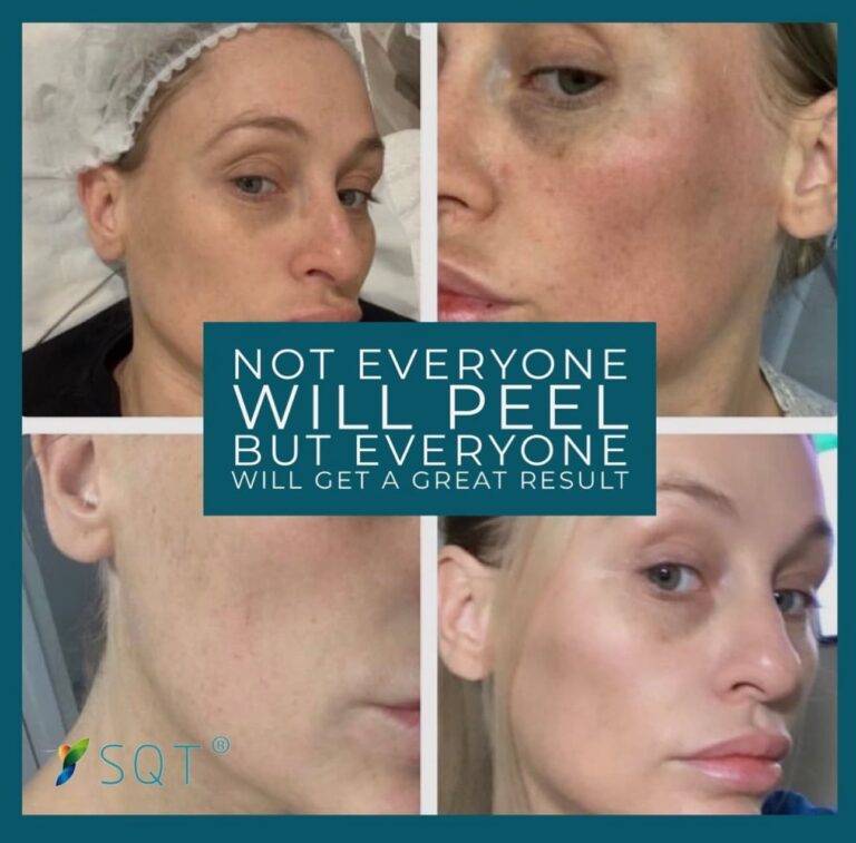 SQT Bio Microneedling - Dr Kara Cosmetic Clinic